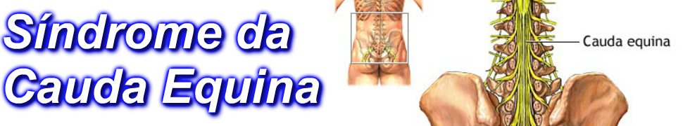 sindrome da cauda equina